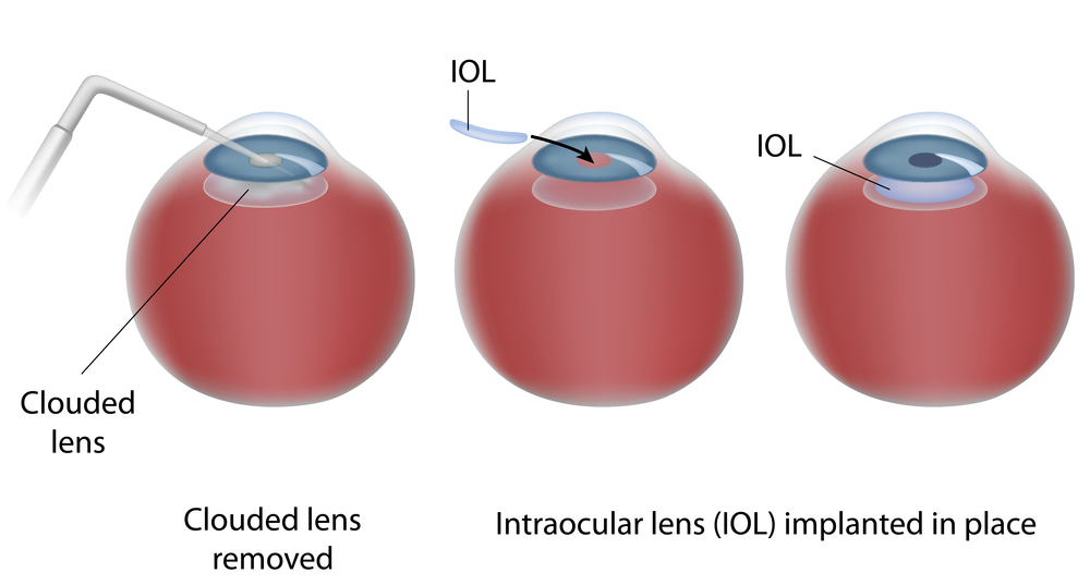 Intraocular Lenses IOLs Sacramento Citrus Heights CA
